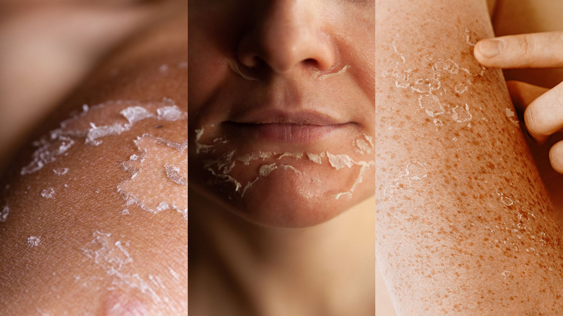 Why Is My Skin Peeling? – GLOWBIOTICS
