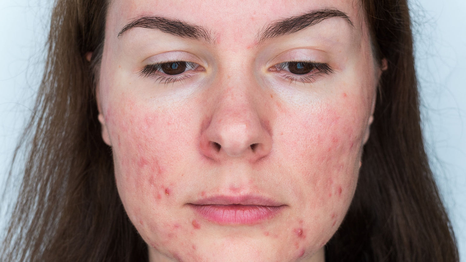 Demystifying Rosacea: Myths vs. Facts About This Skin Condition ...