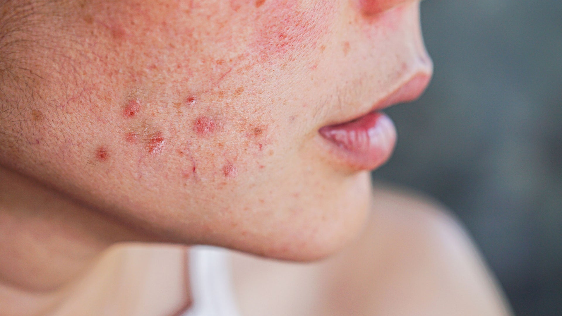 Treatments for Papulopustular Rosacea – GLOWBIOTICS